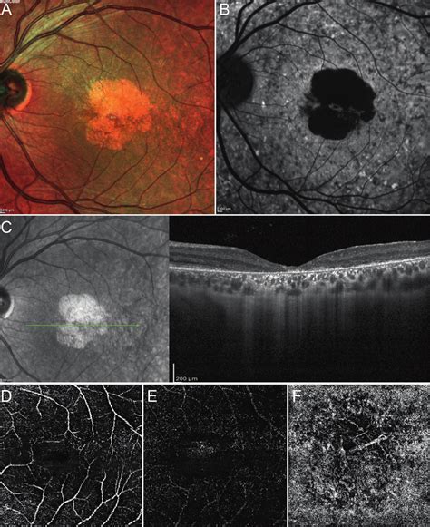 Multimodal Retinal Imaging In Stgd Confocal Multicolor Image A Shows Download Scientific