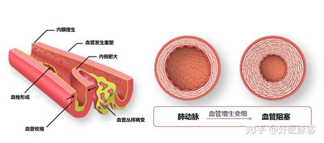 肺高压患者一定要关注右心功能 知乎