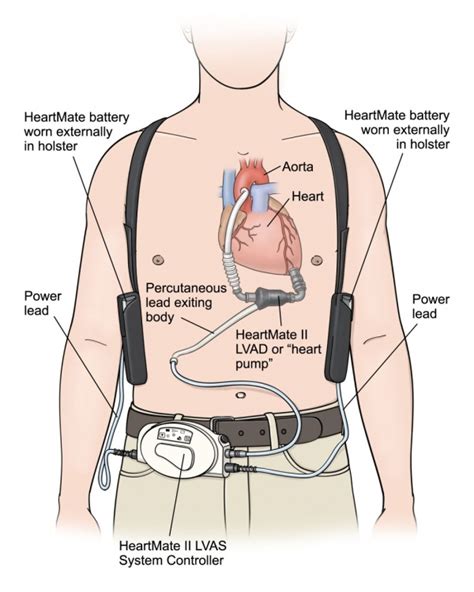 Left Ventricular Assist Device Wikem