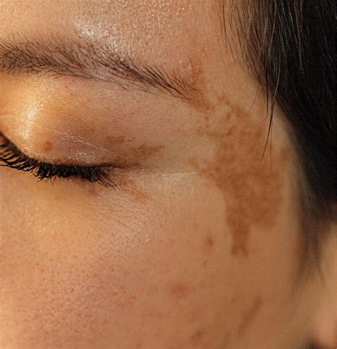 How To Treat Hyperpigmentation Like A Dermatologist Remedy Science By
