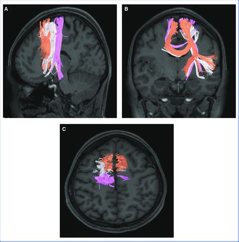 Combined Structural Connectivity Of The Supplementary Motor Area In The Download Scientific