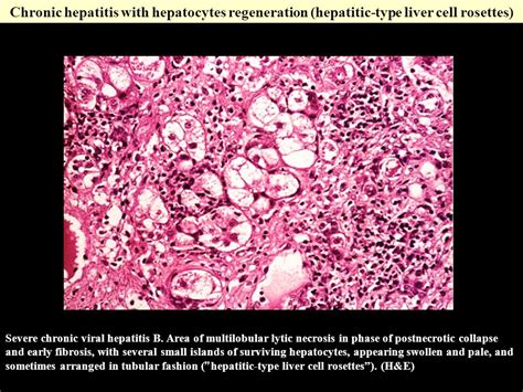 Hepatitis B Ground Glass Hepatocytes
