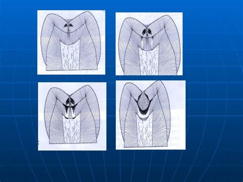 Classification Of Dental Caries PPT