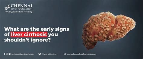 How Do You Treat Jaundice In Newborns Chennai Liver Foundation