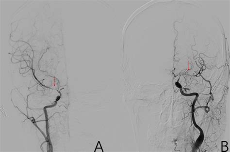 A Is A 45 Year Old Female This Is A Dsa Image Of His Right Common Download Scientific