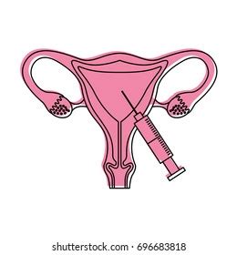 Female Reproductive Organ Injection เวกเตอรสตอก ปลอดคาลขสทธ 1019042791 Shutterstock