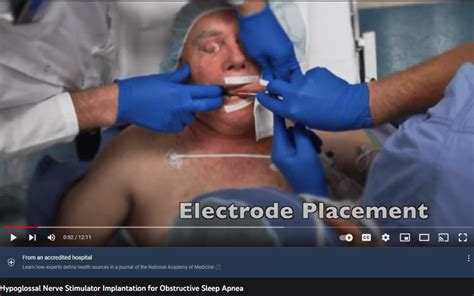 How To Run Hypoglossal Nerve Stimulation For Obstructive Sleep Disorder Intraoperative