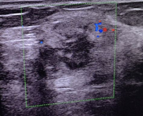 Breast Ultrasound Showing Hypoechoic Mass In The Right Breast Bi Rads