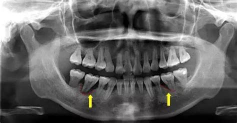 警惕！牙周炎会慢慢腐蚀掉你的骨头