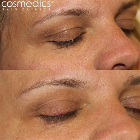 Skin Tag Removal And Treatment Laser Cosmedics Skin Clinics