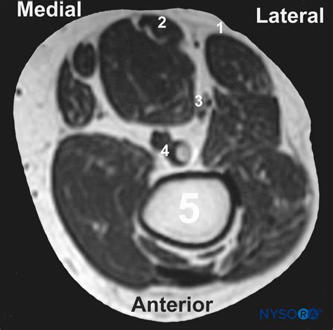 Popliteal Sciatic Nerve Block Landmarks And Nerve Stimulator Technique NYSORA NYSORA
