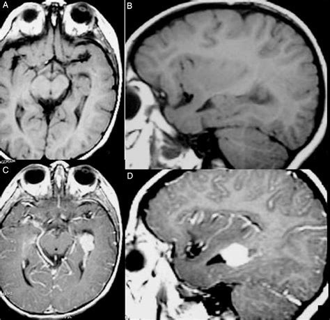 Choroid Plexus Calcification Semantic Scholar