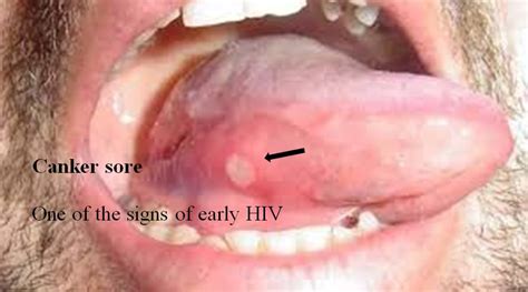 Early Or “acute” Hiv Mouth Sores Pictures