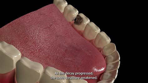 The Exploding Teeth Mystery Of The 1800s Youtube