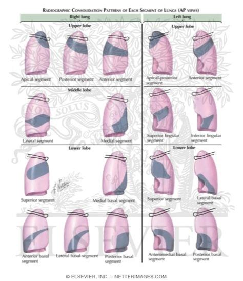 Radiographic Consolidation Patterns Of Each Segment Of Lungs Ap Views