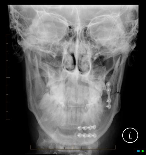 Mandibular Fracture 1 Buyxraysonline