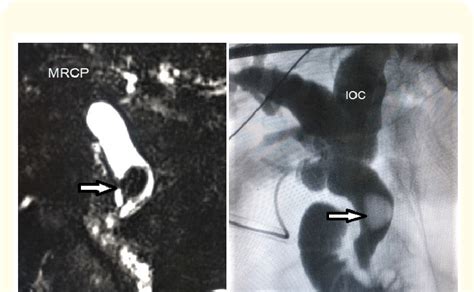 Mrcp And Intraoperative Cholangiogram Ioc Demonstrating Download