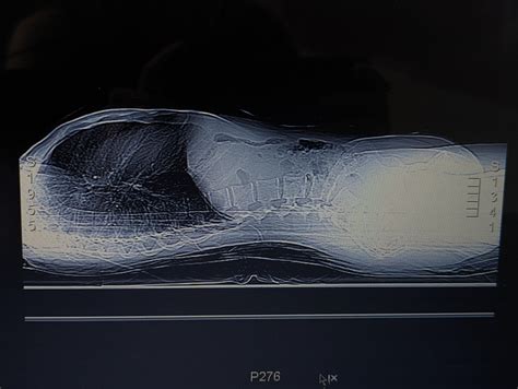 Not Long Ago I Learned That I Had A Lumbarization Of S1 I Cant See It