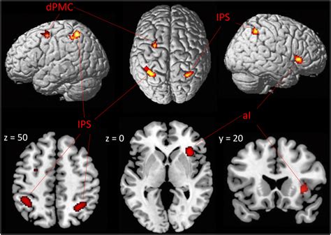 Shared Convergence Of Brain Activation In Dual Tasking And