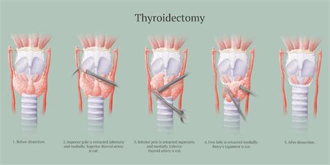 Nutrition Science Easy Learning Hyperthyroidism Part 2