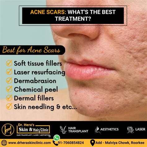 Acne Scars Whats The Dr Heras Skin And Hair Clinic