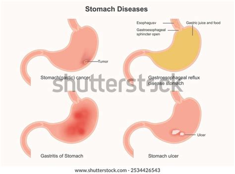 512 Reflux Diagram Stock Vectors And Vector Art Shutterstock