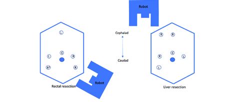 Schematic Diagram Of Port Placement For Robotic Rectal And Liver Download High Resolution