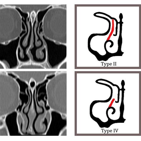 Variations In Superior Attachment Of Uncinate Process Download