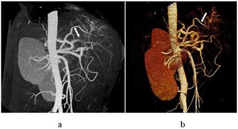 Maximum Intensity Projection A And Volume Rendering Technique B Download Scientific Diagram