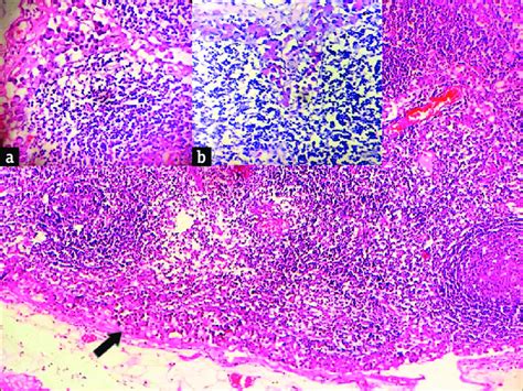 Microphotograph Showing Metastatic Deposits Of Signet Ring Cells In Download Scientific Diagram