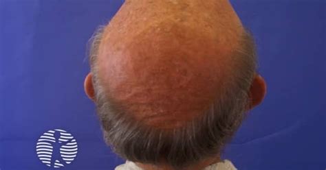 Actinic Keratoses Affecting The Scalp Image