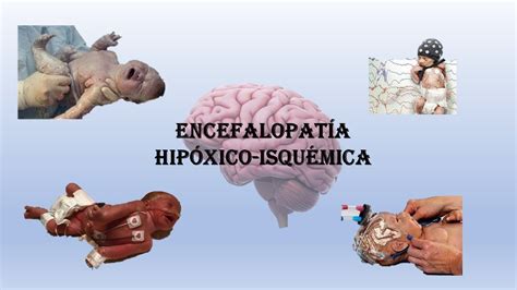 Encefalopatía Hipóxico Isquémica Youtube