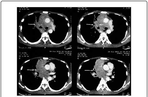 Ct Scan Chest Revealed A Soft Tissue Infiltrative Mass In Anterior