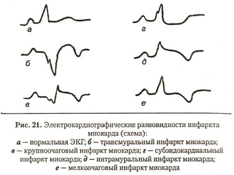 New зүрхний шигдээс