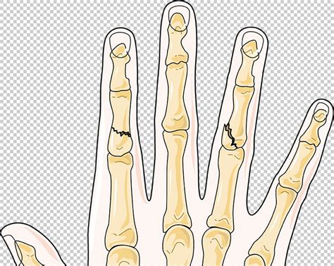 Finger Fractures Vector Finger Fractures Vector
