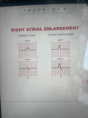 Ekg Flashcards Quizlet