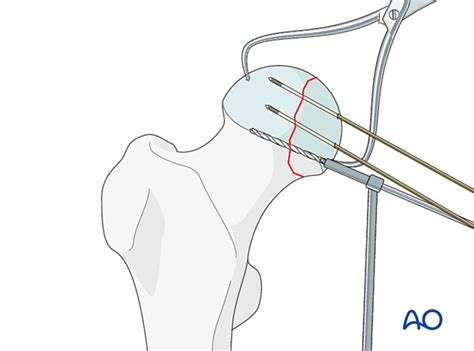 Orif For Femoral Head Fractures With Posterior Wall Fracture Of The Acetabulum