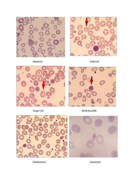 Gambar Eritrosit Abnormal Pdf