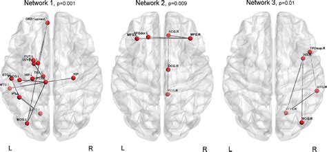 Figure 3 From With Segmental Callosal Agenesis Structural Connectivity