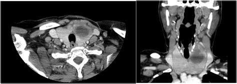 Scielo Brazil Acute Suppurative Thyroiditis With Graves Disease A Very Rare Association