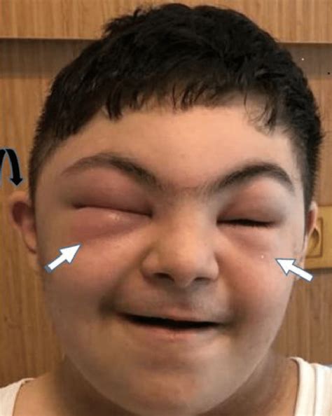 The Right Temporal Swelling Extended Anteriorly To The Right Zygoma And