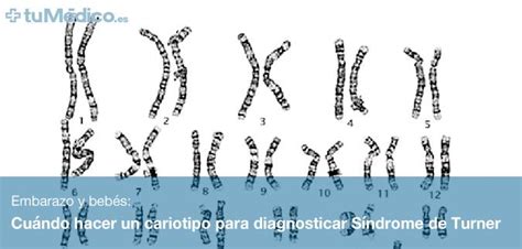 Cuándo Hacer Un Cariotipo Para Diagnosticar Síndrome De Turner