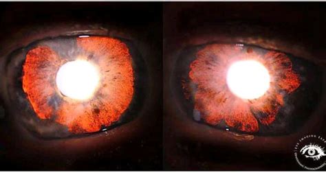 Mutaz Alfadil On Linkedin Iris Transillumination Defects ️iris