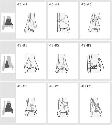 Management Of Pilon Fractures Clinics In Podiatric Medicine And Surgery