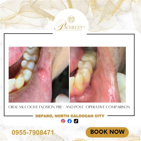 Pacheco Dental Care Center 🔬 Mucocele Removal With Electrocautery Before And After Results 🦷 A