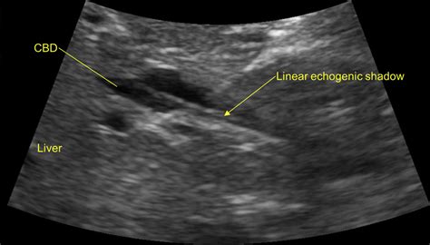 Biliary Ascariasis Mimicker Of Biliary Stent Videogie