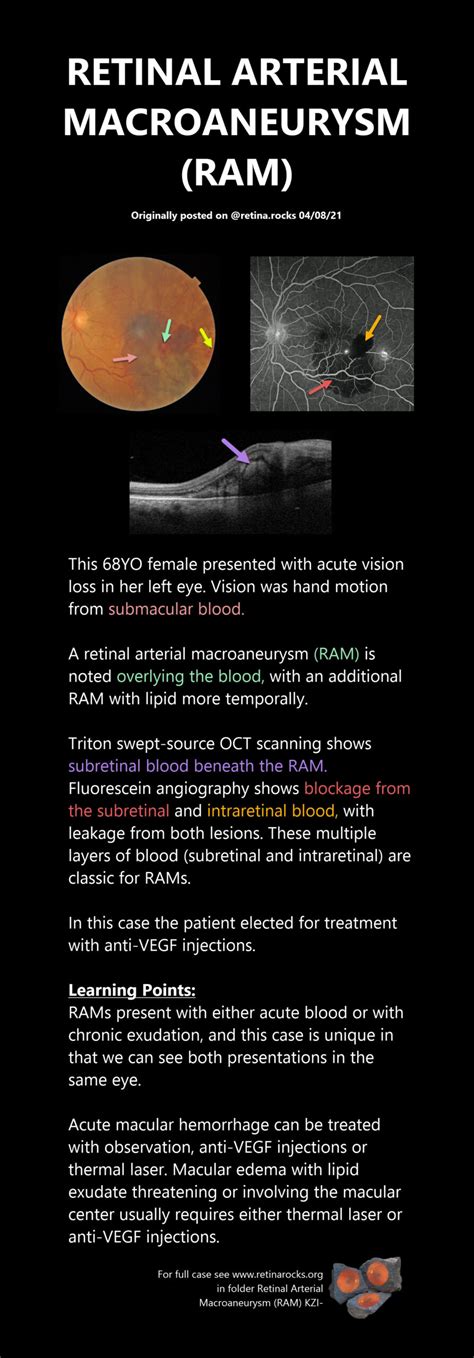 Retinal Vascular Disorders Misc Retinal Arterial Macroaneurysm Ram Retina Rocks