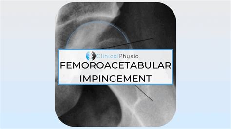Hip Assessment Tests Clinical Physio Membership