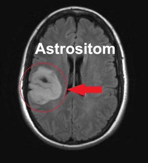 Astrocytoma