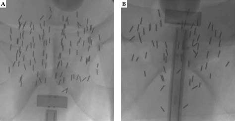 Using A Deep Learning Approach For Implanted Seed Detection On Fluoroscopy Images In Prostate